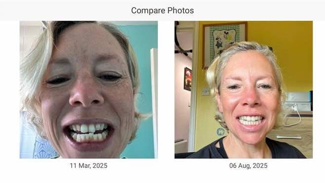 Invisalign review: How I got the smile I’ve always wanted
