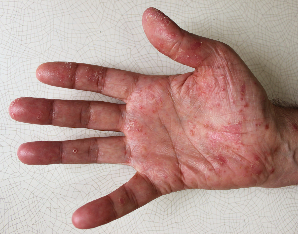 Qu’est-ce que le psoriasis pustuleux