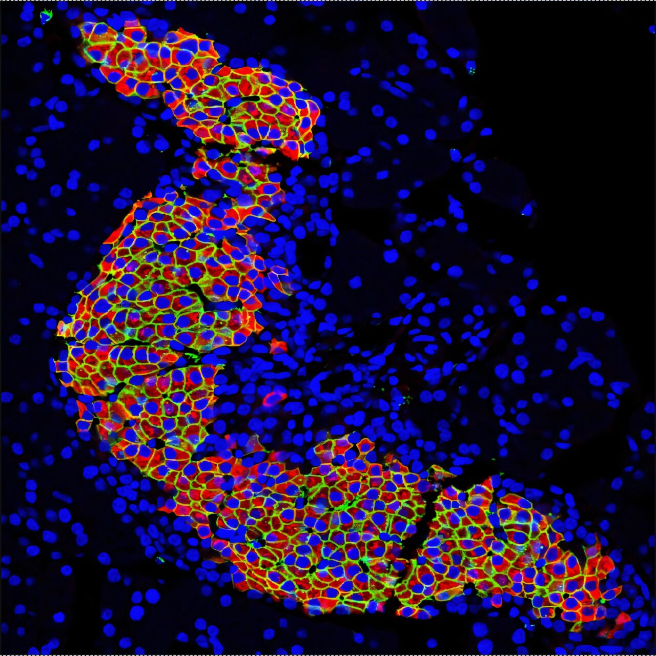 Scrambled RNA nudges millions of people towards type 2 diabetes ...