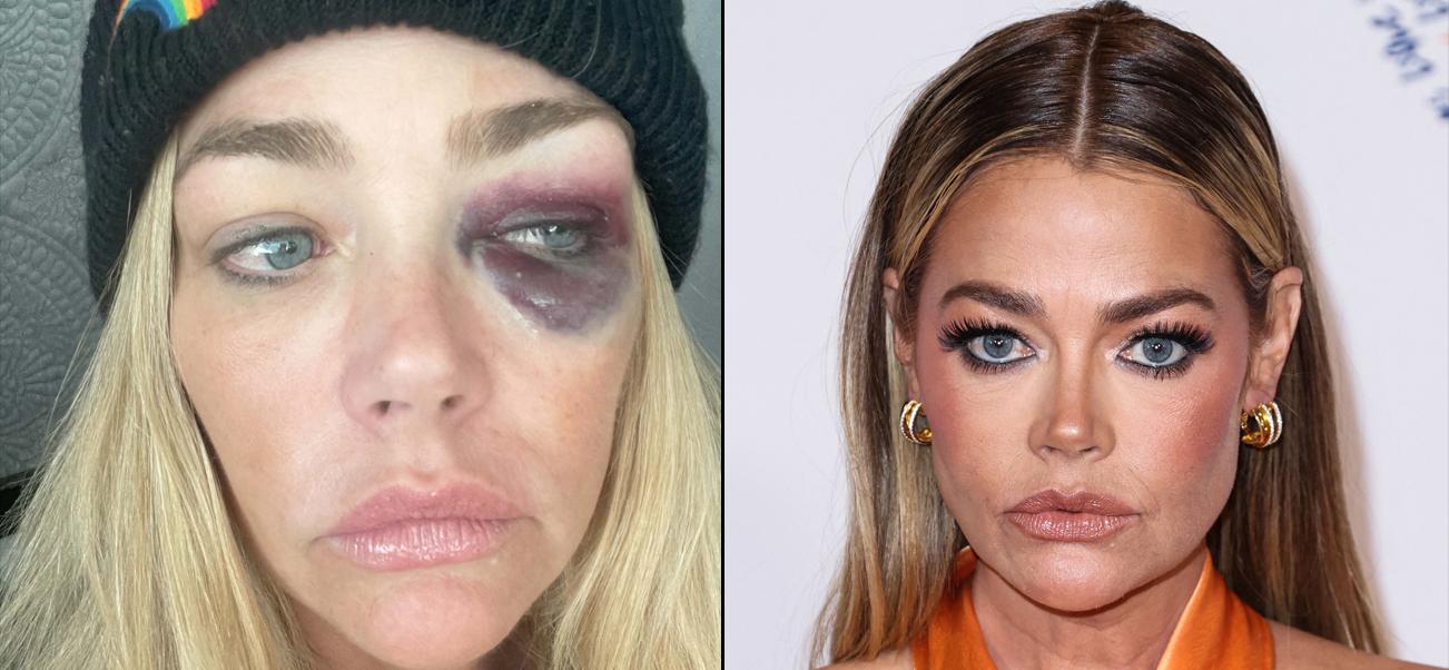 Denise Richards Seen With Black Eye After Expert Predicts Disaster For ...