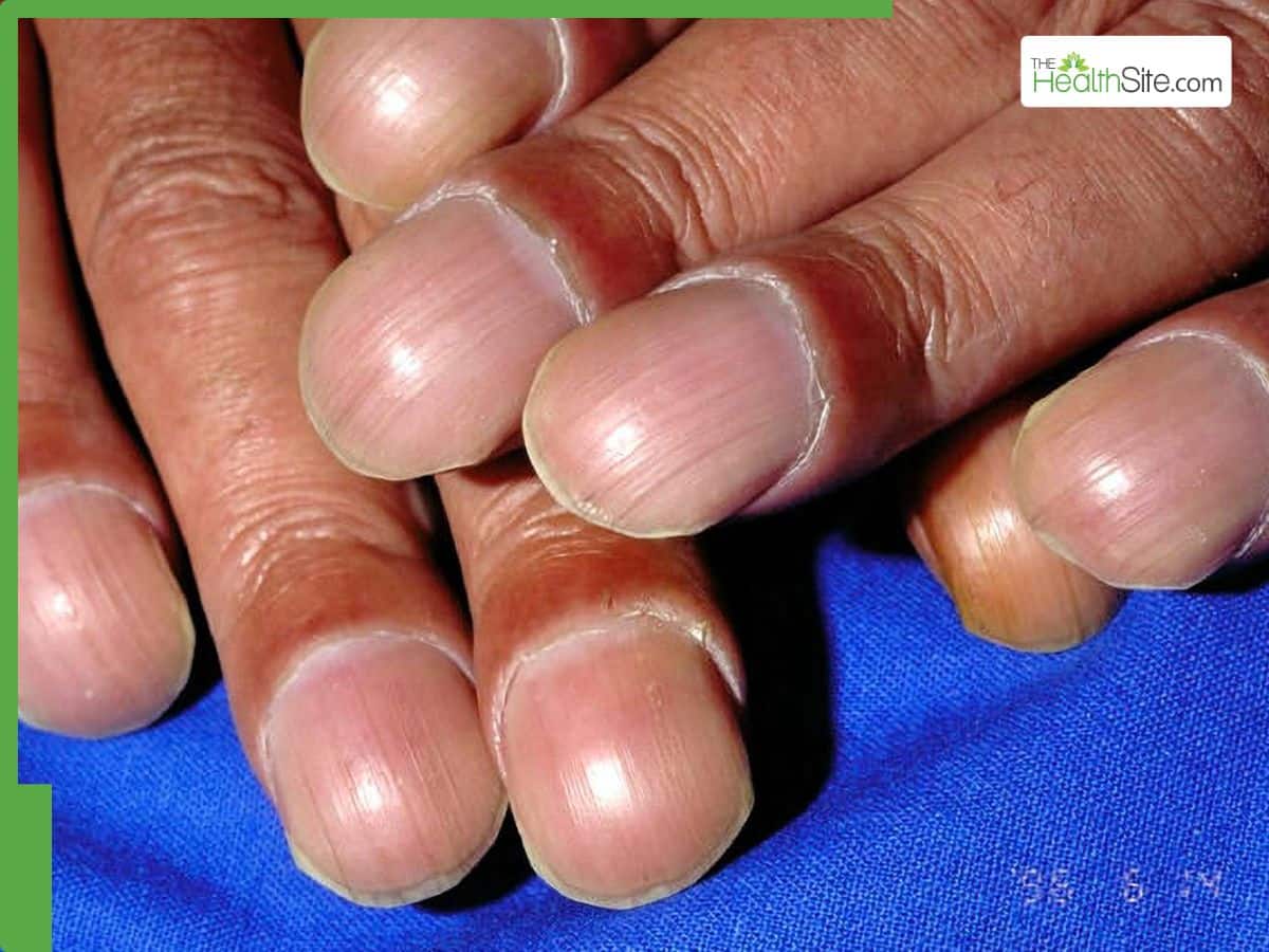 Heart Attack Symptoms: 5 Warning Signs That Appear On Your Nails