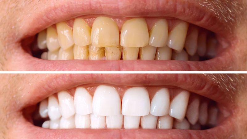 Ni bicarbonato ni limón: cómo sacar el sarro de los dientes de forma ...
