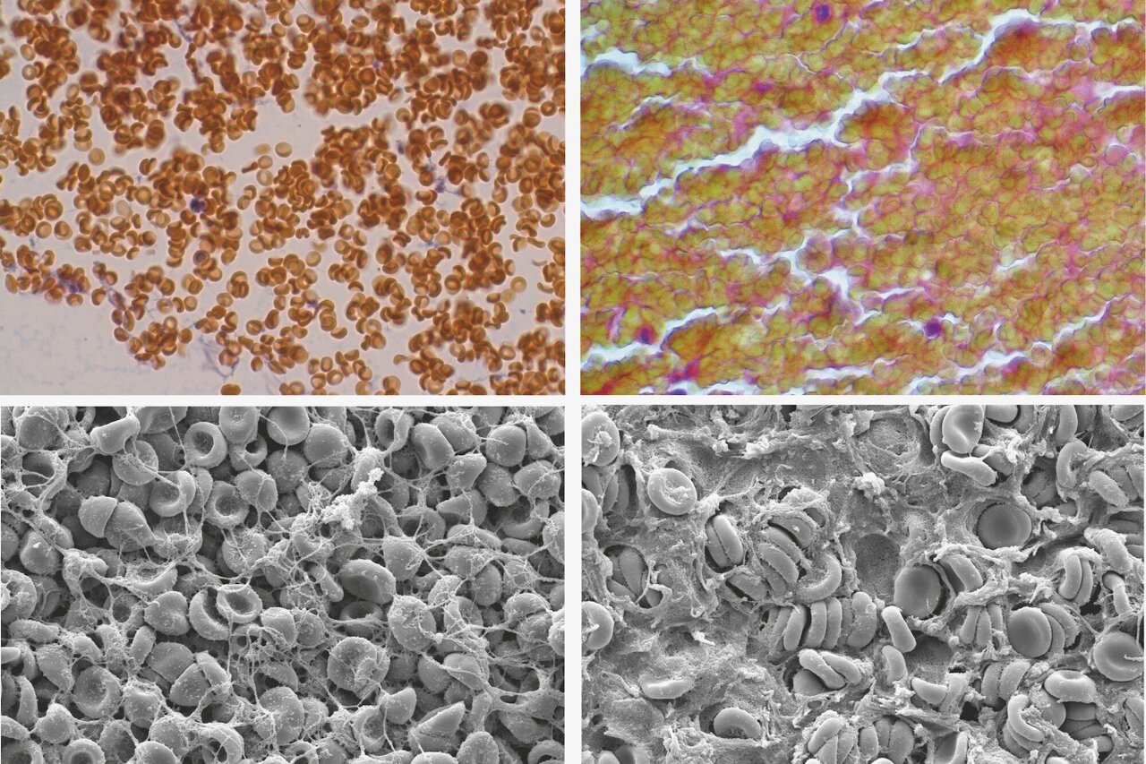 Red blood cells drive blood clot shrinkage, overturning old assumptions