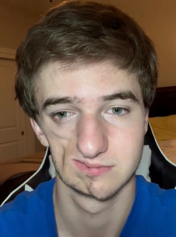 Meet Lukas: His Journey with Parry-Romberg Syndrome and How He Looks Today