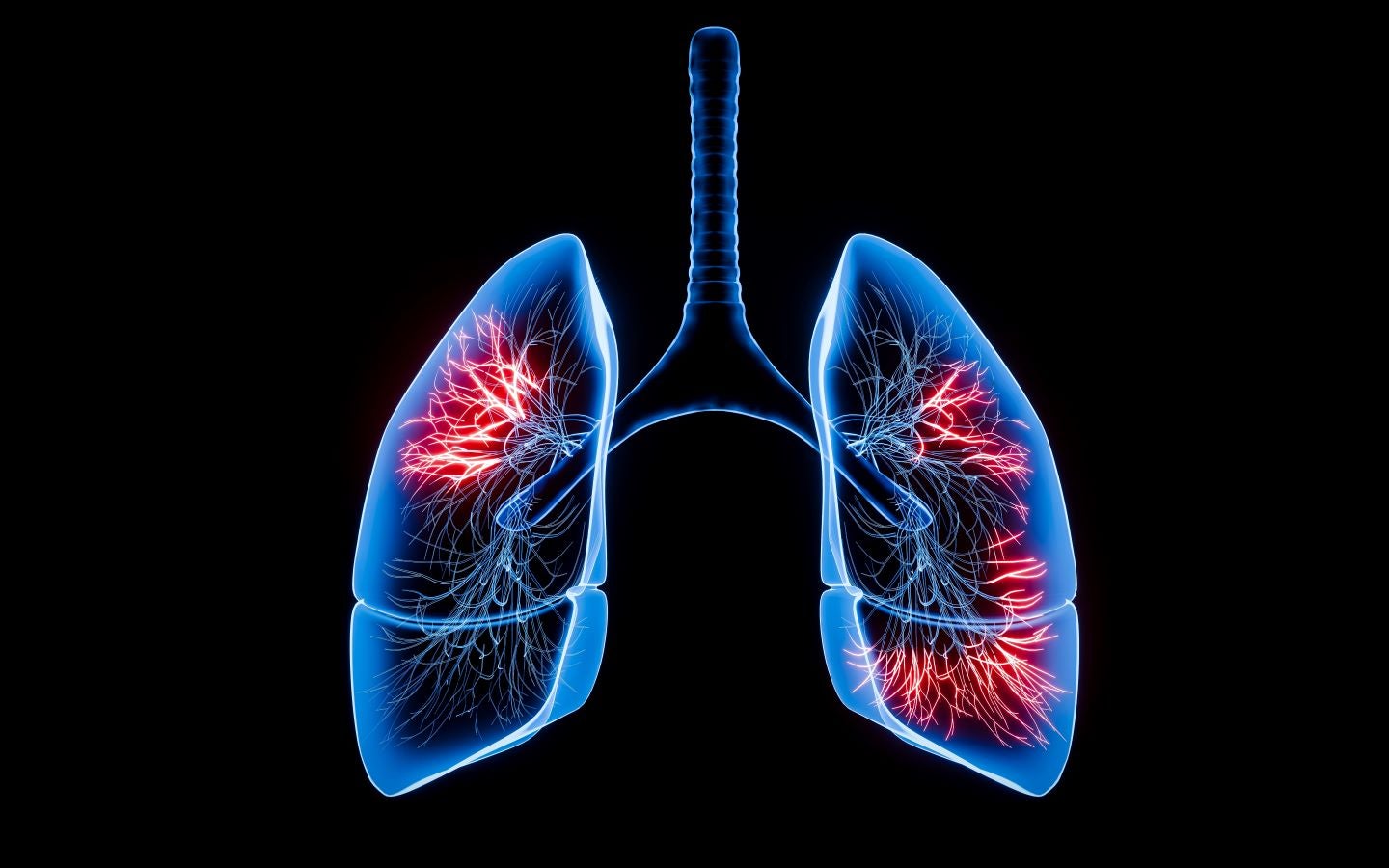 Apreo Health raises $130m to fund emphysema implant pivotal trial