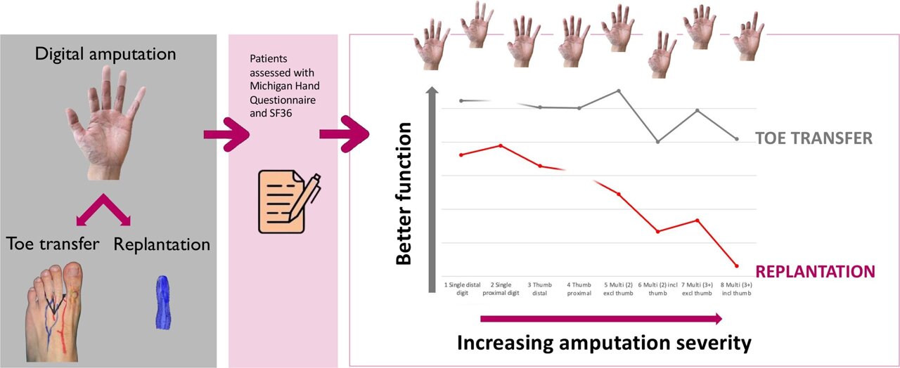Toe transfer surgery may improve outcomes after finger amputation