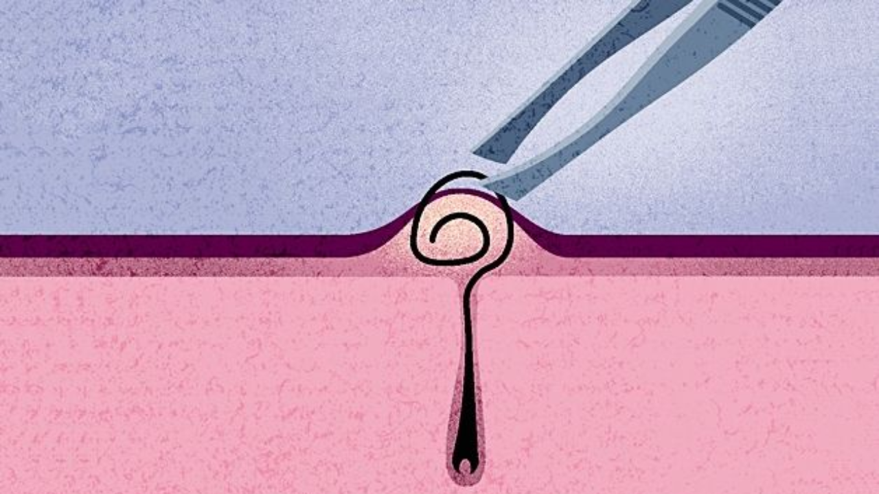 5 quick and easy fixes for ingrown hair