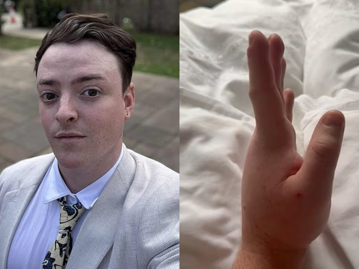 Venomous spider bite in Australia leaves tourist with severely swollen hand