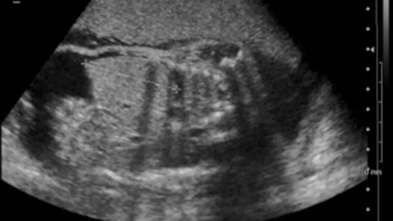 Congenital Syphilis on the rise in New York; three babies dead: All you ...