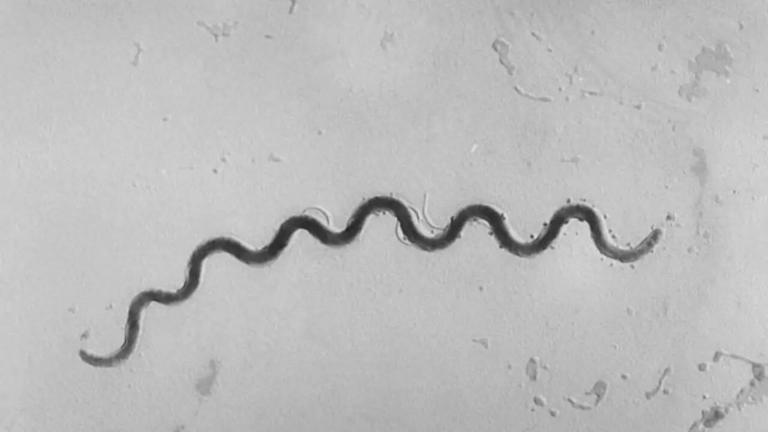 Congenital Syphilis on the rise in New York; three babies dead: All you ...