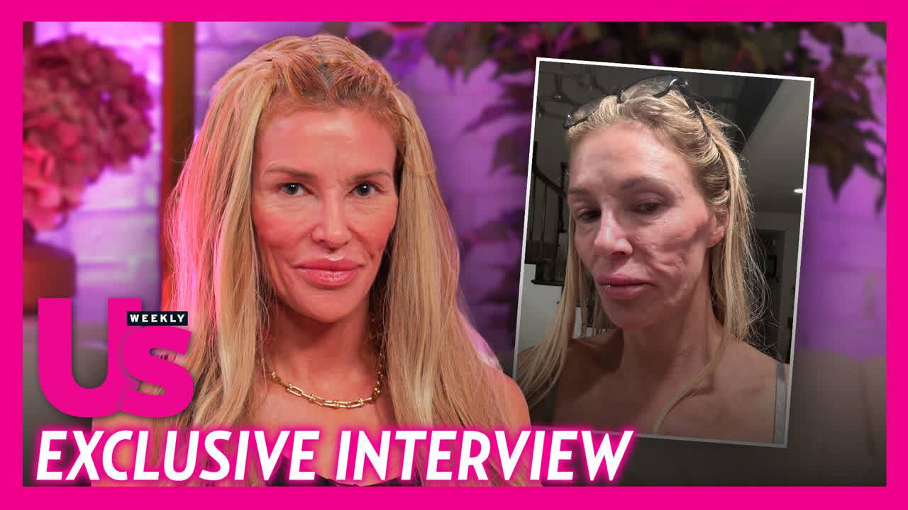 Brandi Glanville and Her New Doctor Detail Facial Disfiguration Treatment