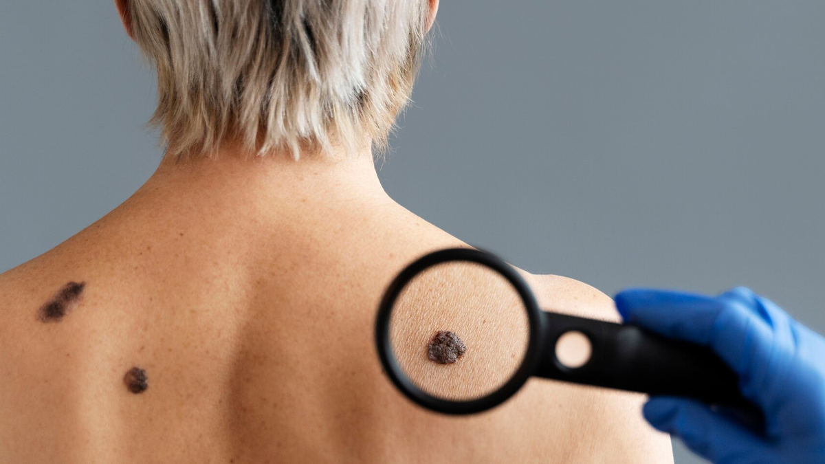 Unusual Moles: The ABCDE Rule for Spotting Skin Cancer Early