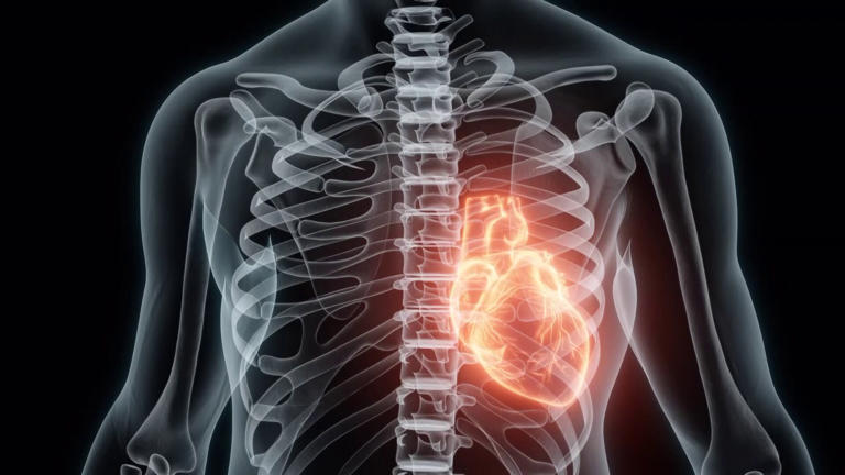 Watchman Implant Procedure for Atrial Fibrillation