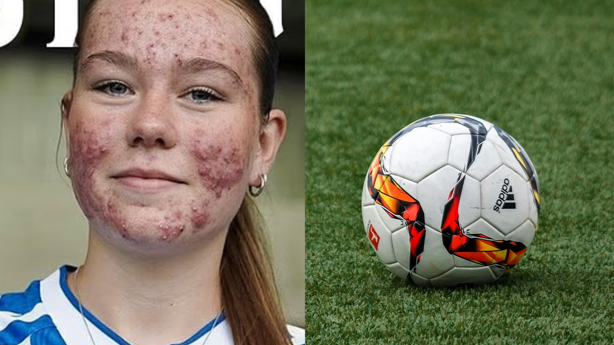 Women's football player bullied online for acne silences trolls ...