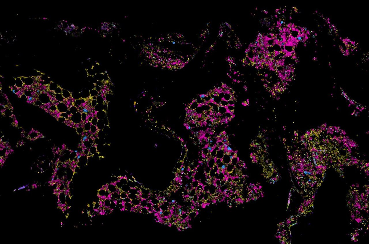 Rethinking myeloma: Bone marrow map reveals hidden complexity of blood ...