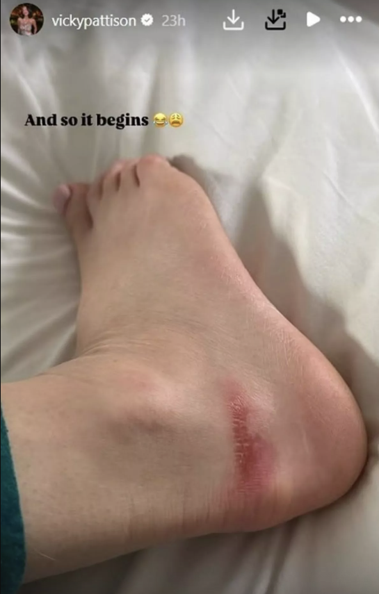 Strictly Come Dancing star left bruised and blistered just days into ...