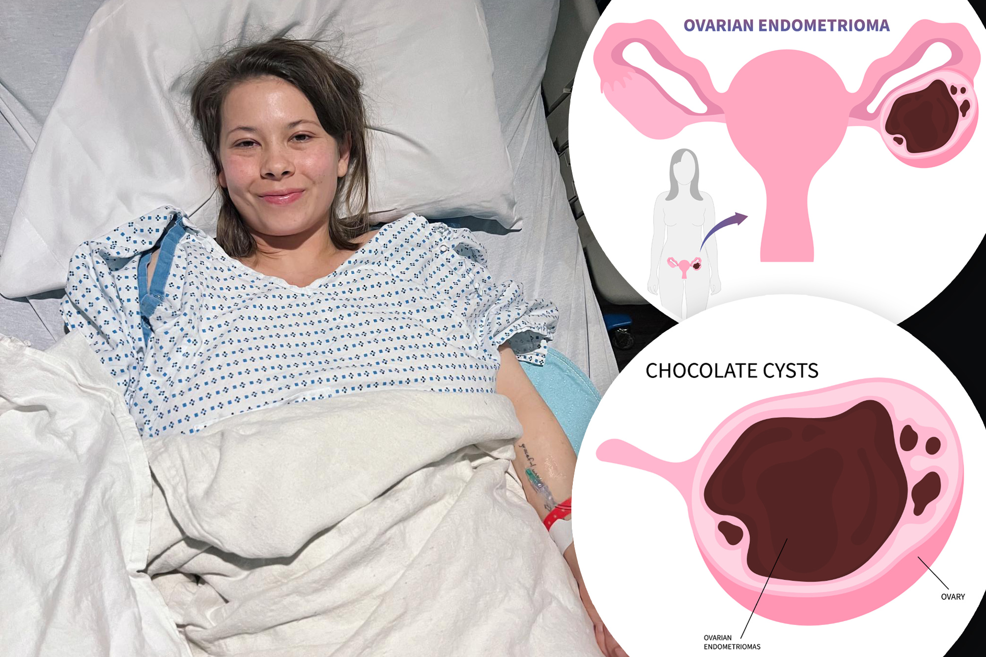 What is a chocolate cyst? The growth Bindi Irwin had removed — along ...