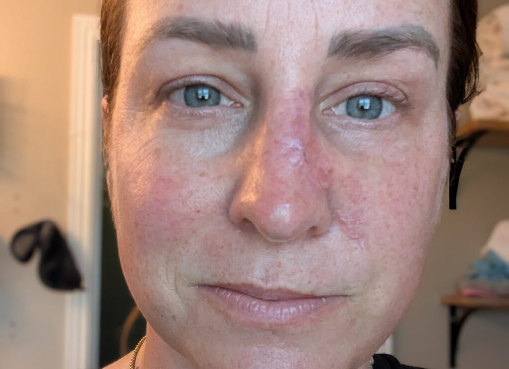 Mom’s ‘dry skin’ on nose turned out to be skin cancer – despite ...