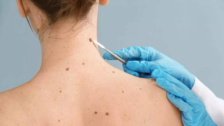 Skin cancer symptoms you might miss and how to spot them early