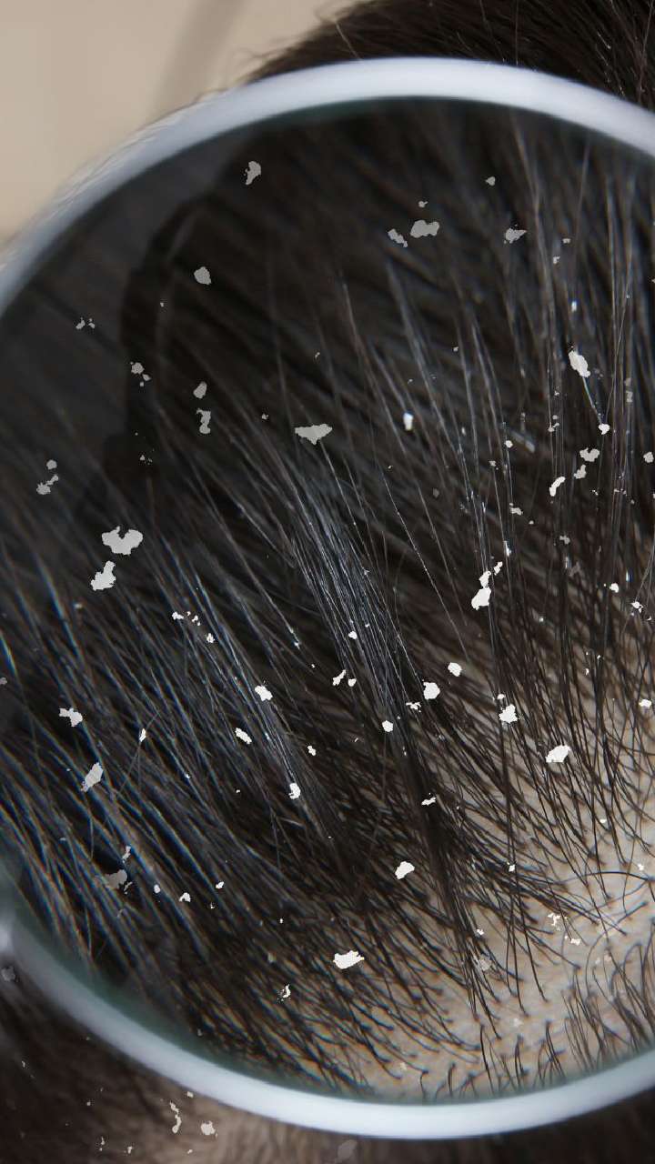 Effective Home Remedies To Treat Dandruff In Kids