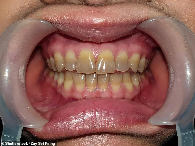 What the colour of your TEETH says about you, according to science