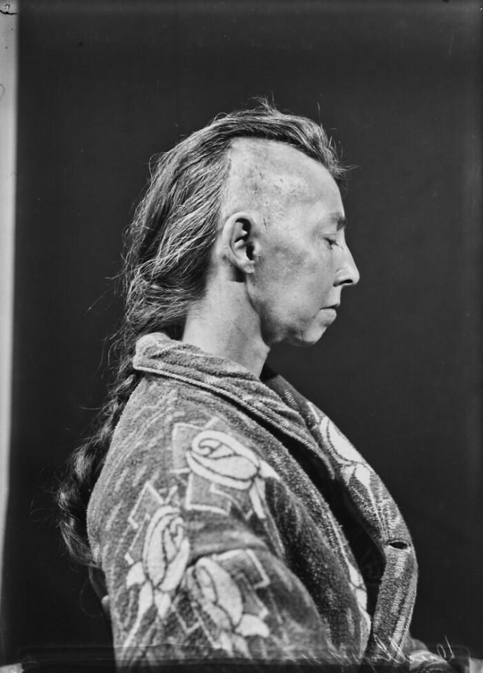 13 Haunting Medical Portraits Of Harvey Cushing’s Patients In The Early ...