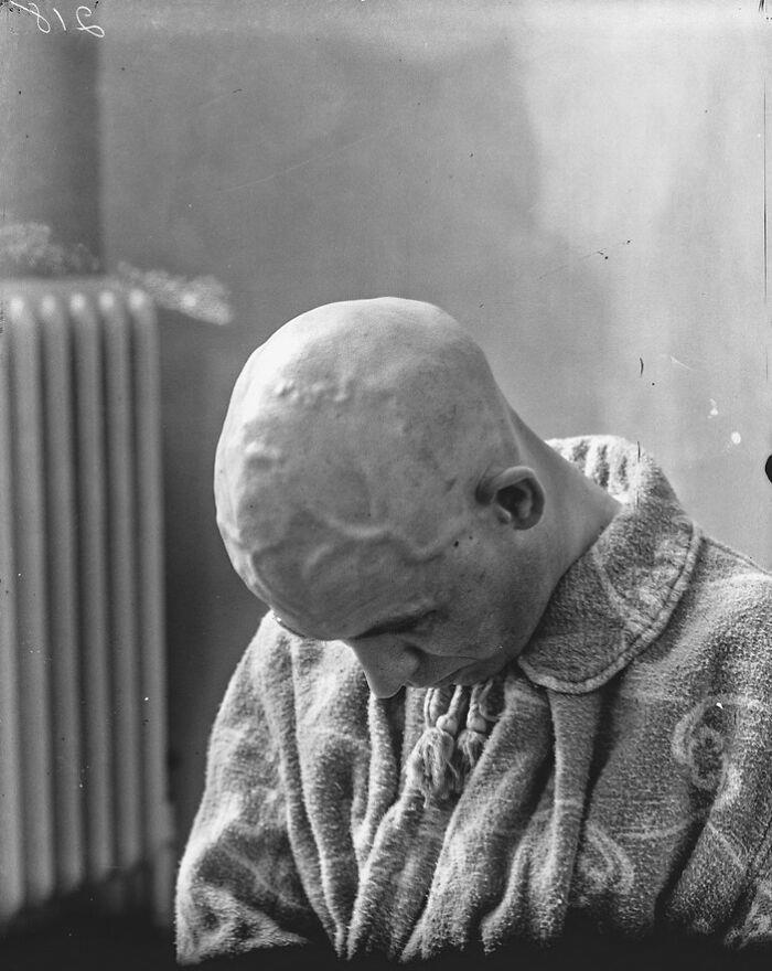 13 Haunting Medical Portraits Of Harvey Cushing’s Patients In The Early ...