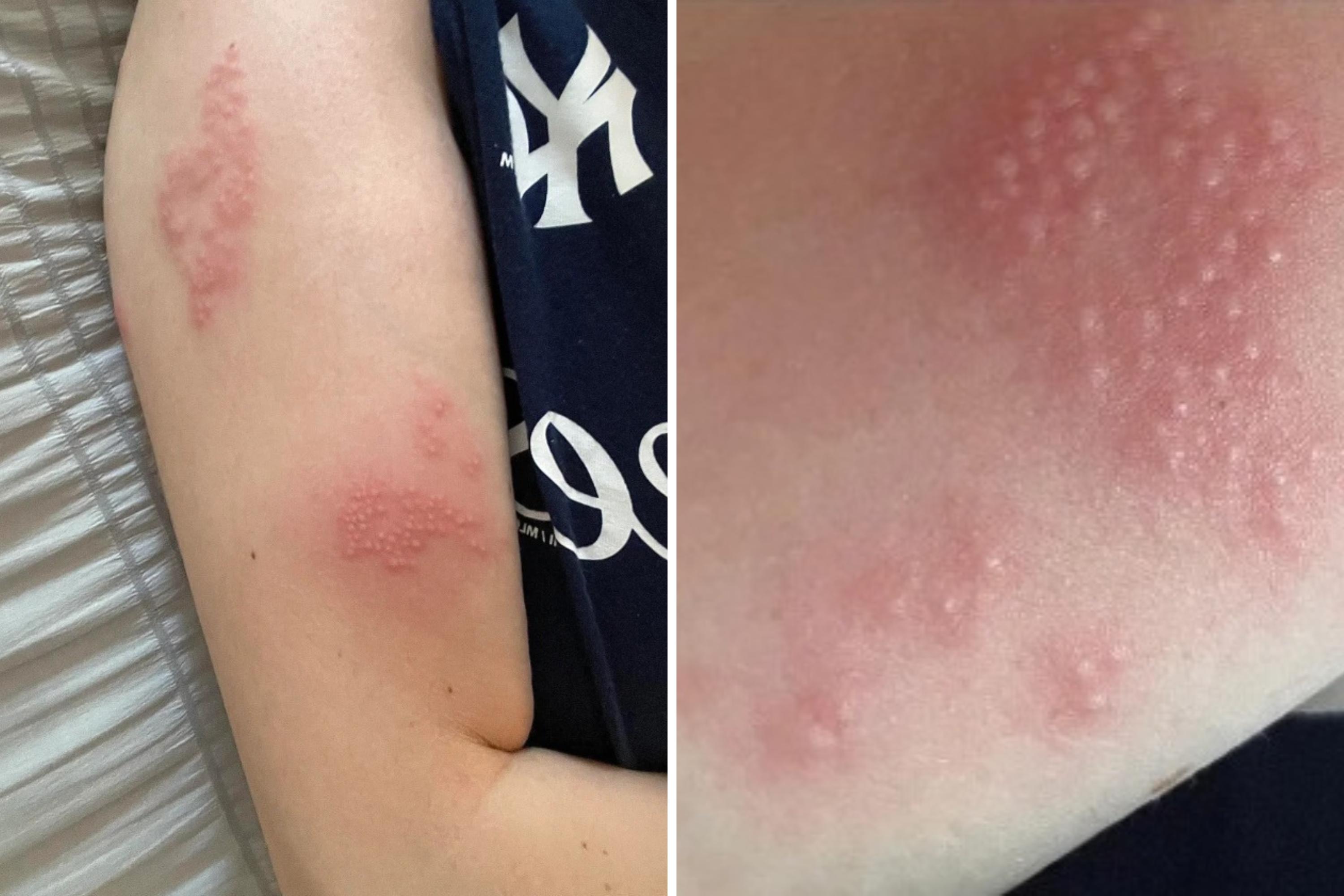 Gen Z woman sees rash on arm after swimming in pool, then comes diagnosis