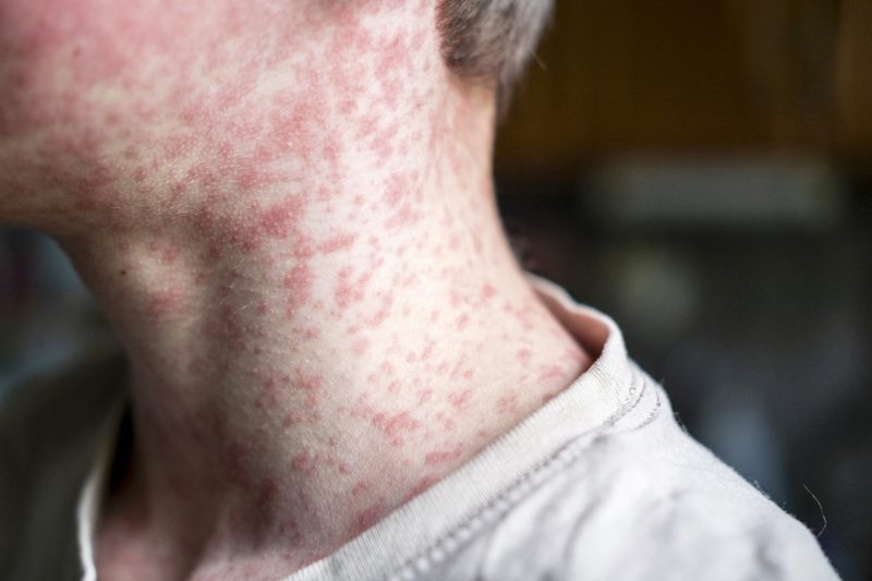 Measles exposure reported at Fairfax County grocery store: health officials
