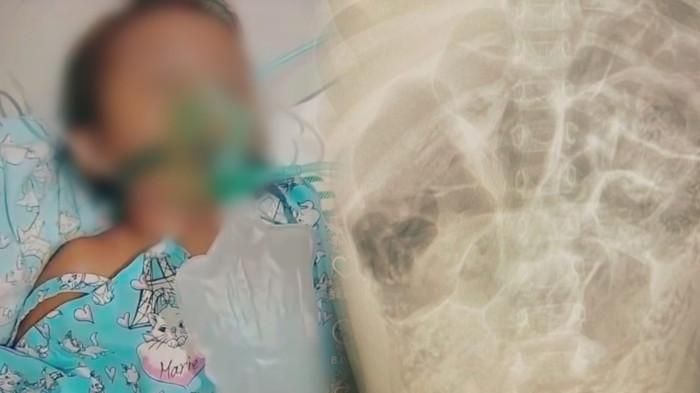 Penyebab Tubuh Bocah 4 Tahun Dipenuhi Cacing hingga Meninggal Dunia di ...