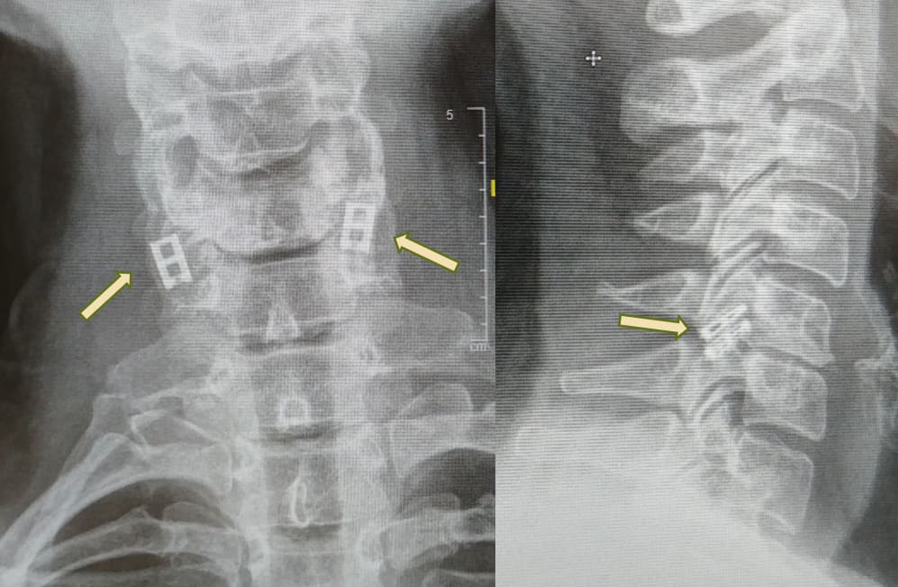 World's first spinal cord transplant to take place in Israel, could ...