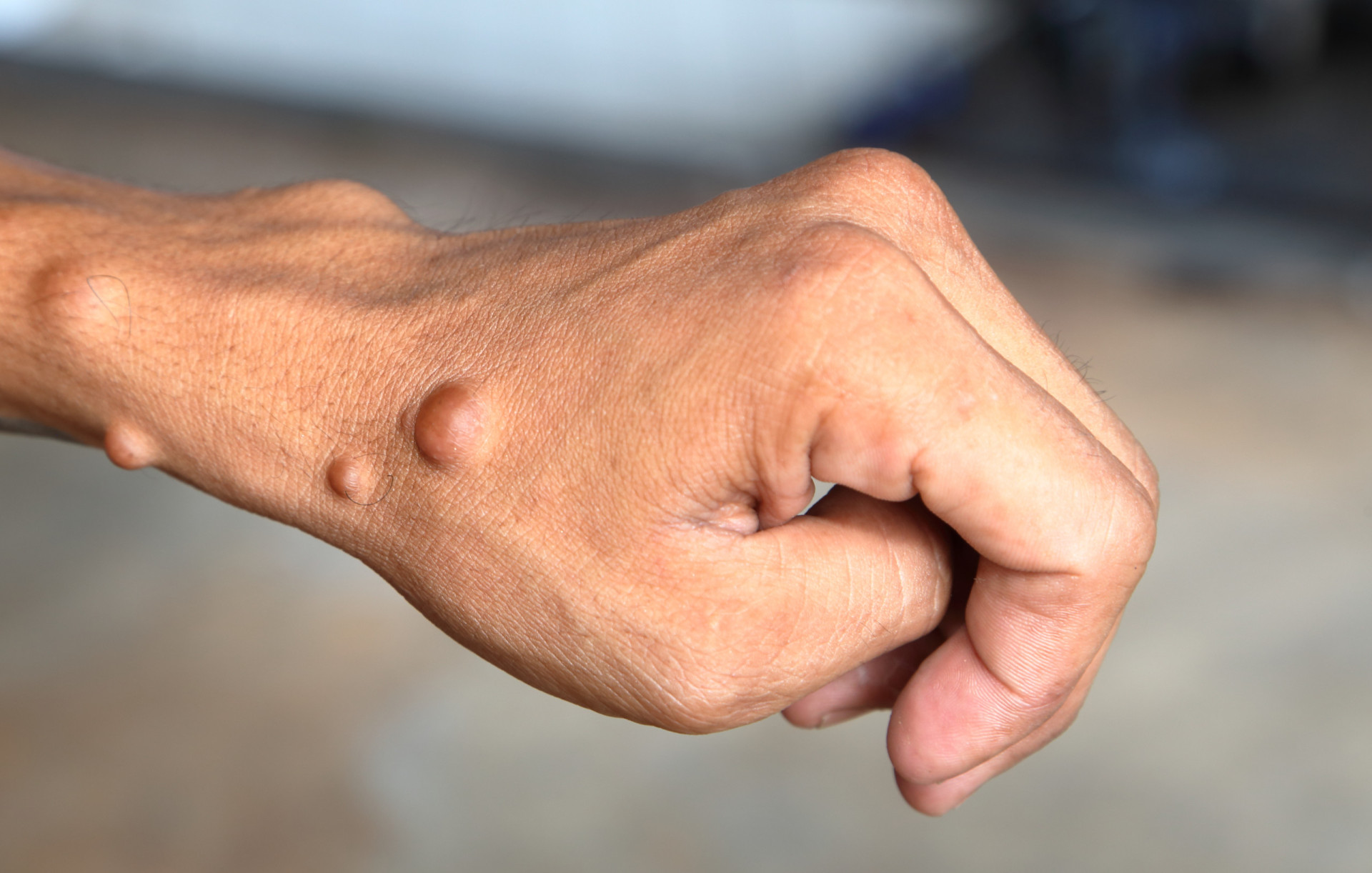 Neurofibromatosis: when tumors develop on nerves