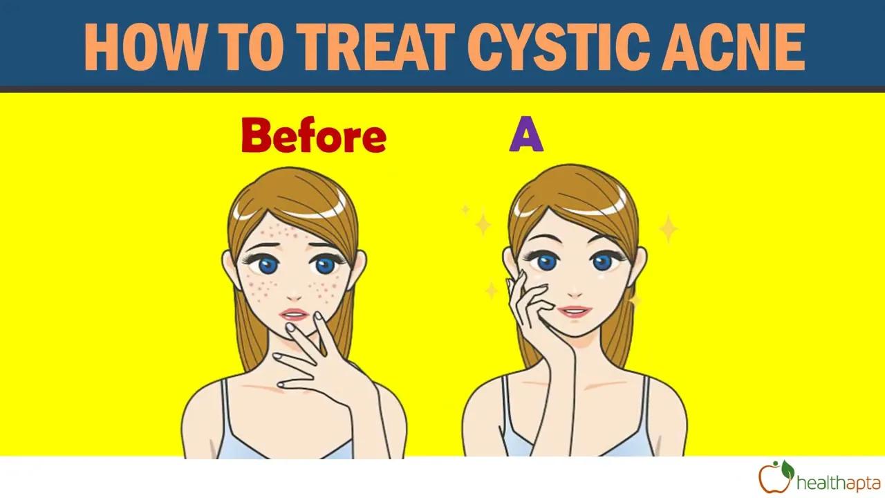 How To Treat Cystic Acne