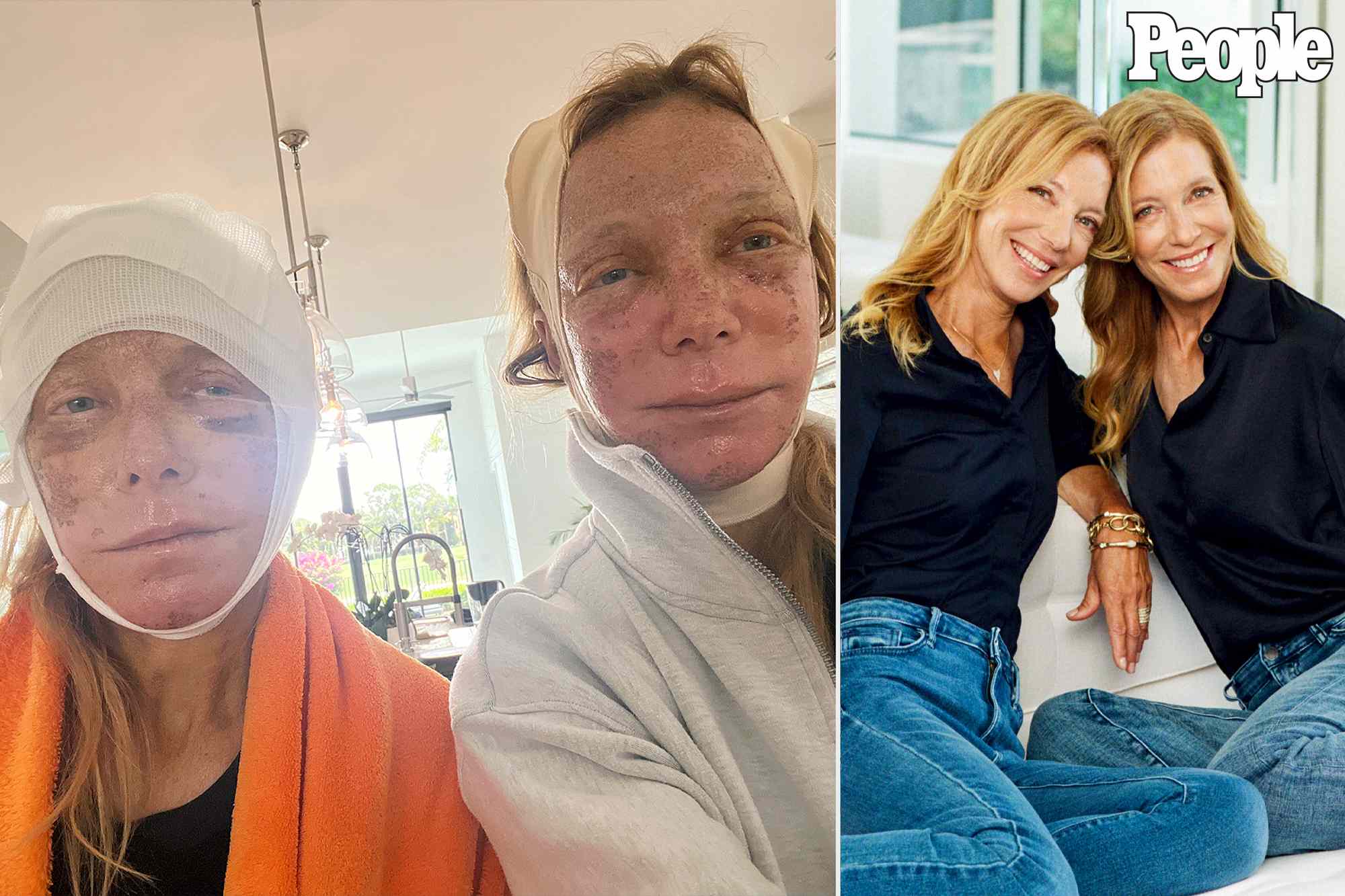 Identical Twins Get Identical Facelifts Hours Apart. How the ...