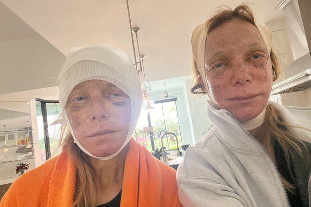 Identical Twins Get Identical Facelifts Hours Apart. How the ...