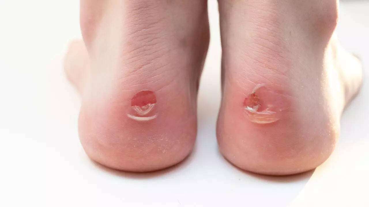 How to heal blisters safely at home with natural remedies and ...