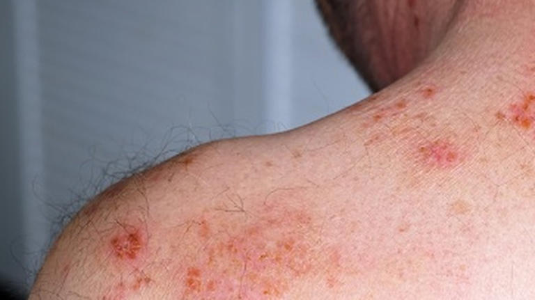 The Commonly Mistaken Sign Of Shingles You Shouldn't Ignore