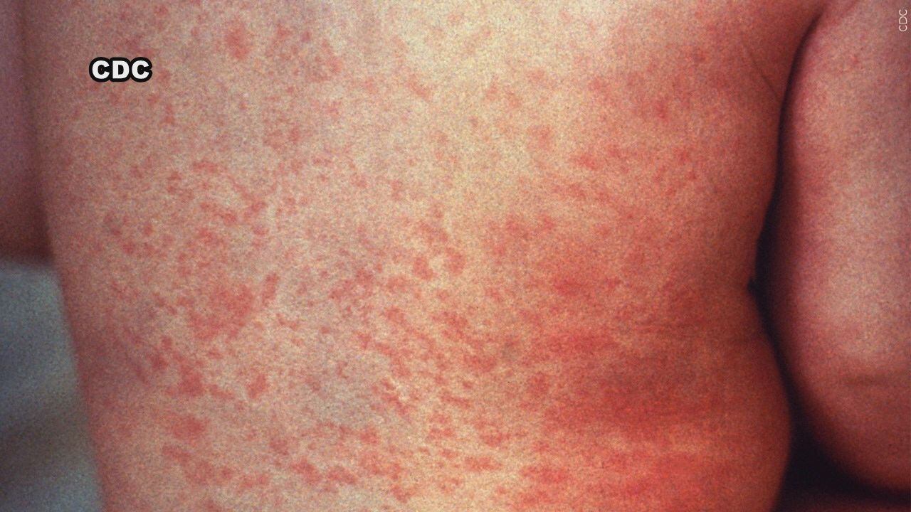 Measles outbreak officially ends in southwest Kansas