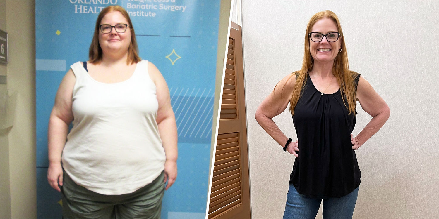 Woman Loses 220 Pounds With Rare Surgery That Leads to 'Dramatic ...