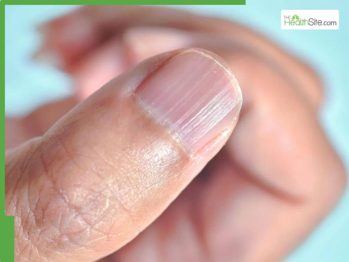 High cholesterol symptoms: 7 warning signs that may show up in your nails