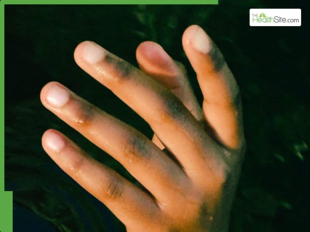 High cholesterol symptoms: 7 warning signs that may show up in your nails