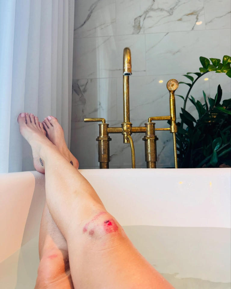 Katy Perry shows off brutally scraped knees she sustained during her ...