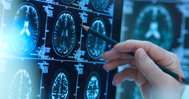 Doctors Alarmed After 'AI' Invents a Brain Part That Doesn't Even Exist ...