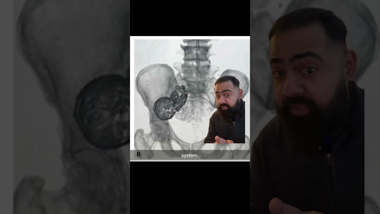 Doctor Explains the Stone Baby Phenomenon - Real-Life Medical Glitch