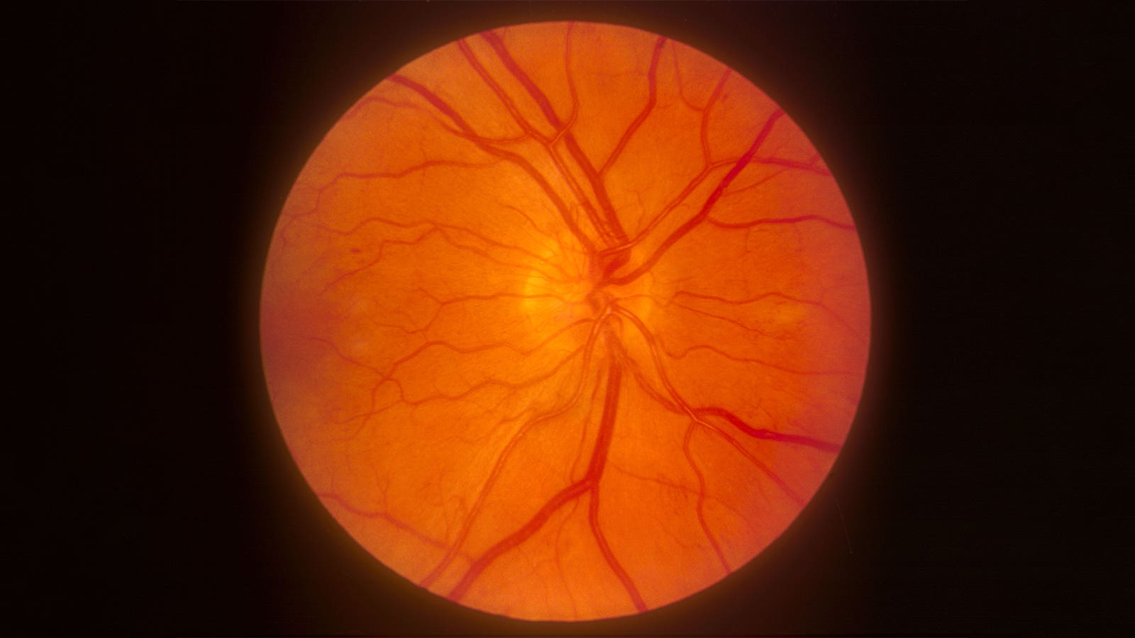 Popular Diabetes Drugs Linked to Small Risk of Retinal, Optic Nerve ...