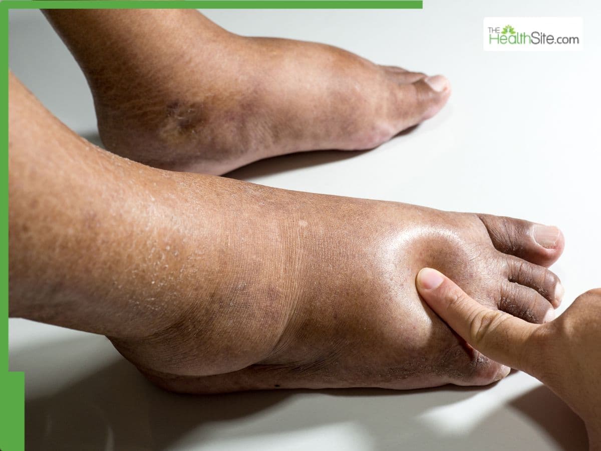 5 Dangerous Diseases That Can Lead To Unusually Swollen Feet At Night