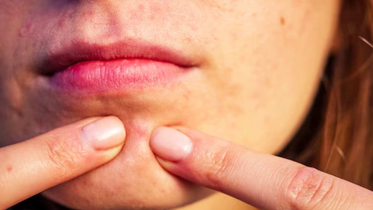 How To Distinguish Between PCOS Acne Vs. Normal Acne