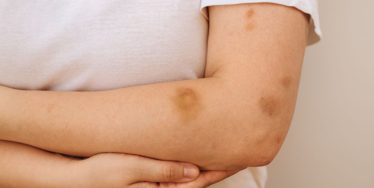 7 Surprising Reasons You Bruise So Easily, According to Doctors