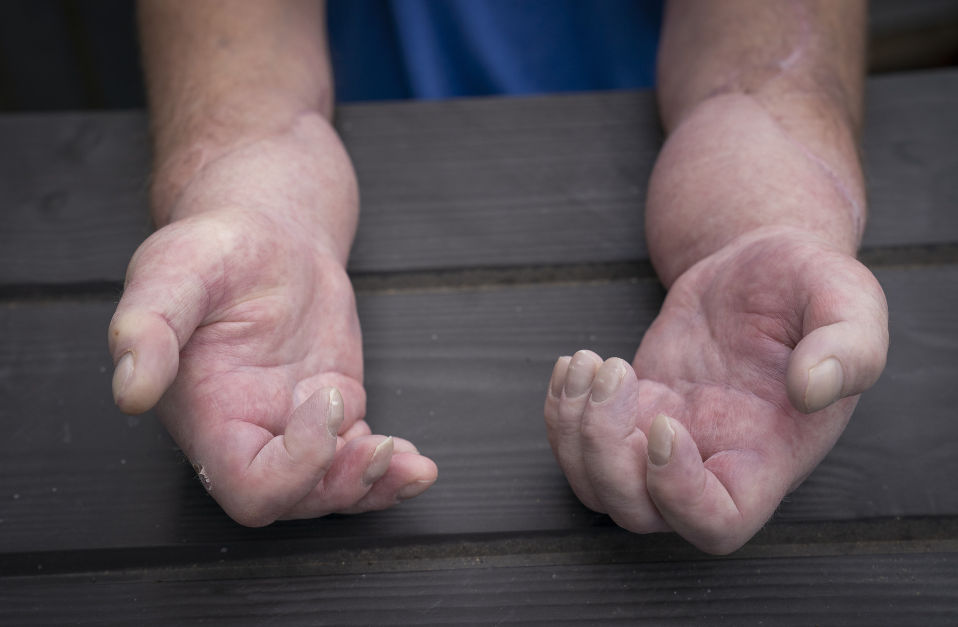 Scleroderma: what you should know about this rare disease