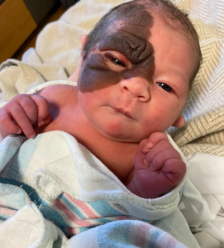 Mom Turns Daughter’s Rare Birthmark Into a Beautiful Superpower